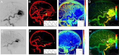 Validation Of Cerebral Arteriovenous Malformation Hemodynamics Assessed