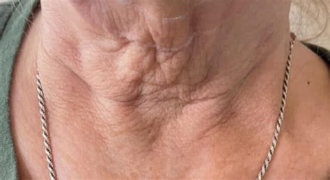 Neck Pdo Thread Lift Elite Medi Spa