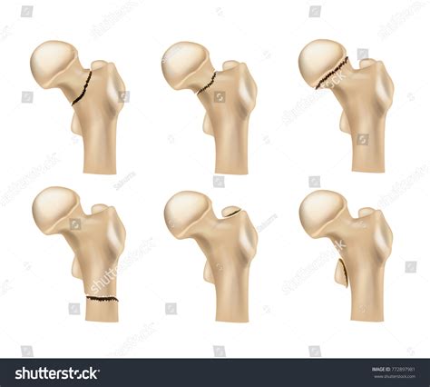 Vektor Stok Basic Types Hip Fractures Femoral Neck Tanpa Royalti