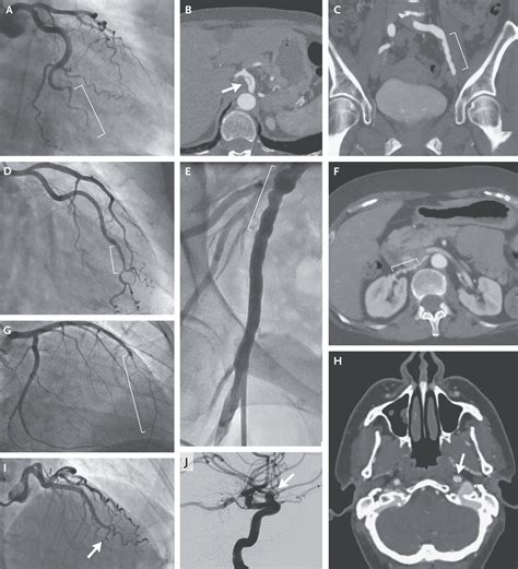 Spontaneous Coronary Artery Dissection NEJM