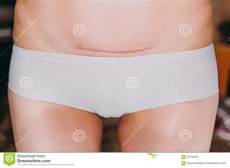 Closeup Of Woman Belly With A Scar From A Cesarean Section Stock Image