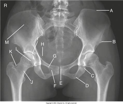 Bontrager Femur Pelvic Girdle Chapter 7 Image Critique Flashcards