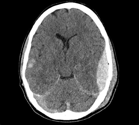 CT Case LITFL CT Scan Interpretation