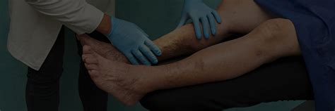 Varicose Vein Treatments Vein Solutions South Africa