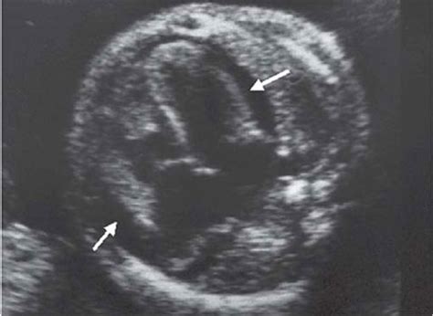 Pericardial Fluid Ultrasound