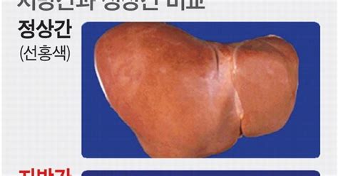 하루 소주 반 병 이상 마시는 지방간 환자 심혈관질환 위험 28 증가