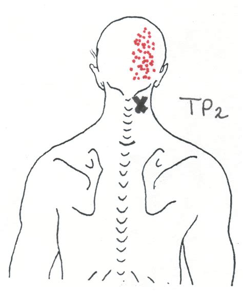 Semispinalis Cervicis © Copyright American Academy Of Manual Medicine
