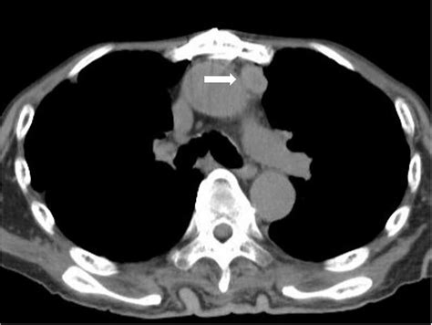 Chest Ct Scan 18 Months After Surgery Mediastinal Lymph Node Download Scientific Diagram
