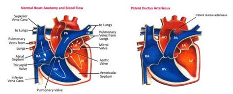 Left To Right Shunt Lesions Patent Ductus Arteriosus Pda