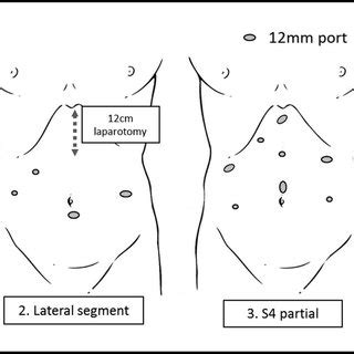 PDF Laparoscopic Hepatectomy Is Easier In Repeat Hepatectomy