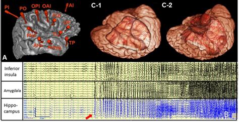 A Stereo Electroencephalography Brain Map Demonstrating Coverage Of