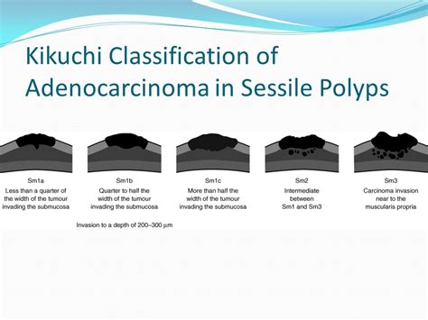 Treatment Of Early Malignant Rectal Polyp Ppt Video Online Download