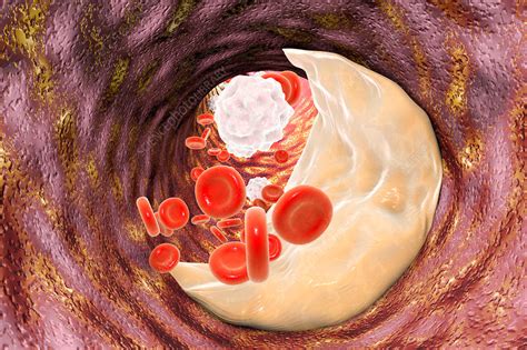 Atheromatous Plaque Illustration Stock Image F Science Photo Library