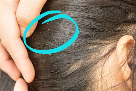 Lice And Your Bedding A Closer Look Licefreee