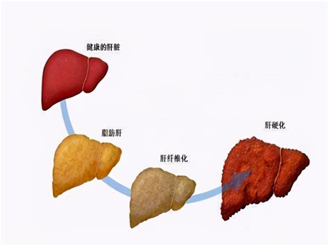 肝纤维化图片 肝纤维化病理图片 伤感说说吧
