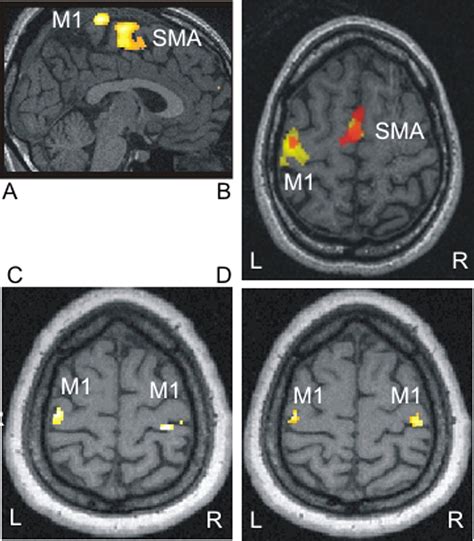 Congenitally Altered Motor Experience Alters Somatotopic Organization Of Human Primary Motor