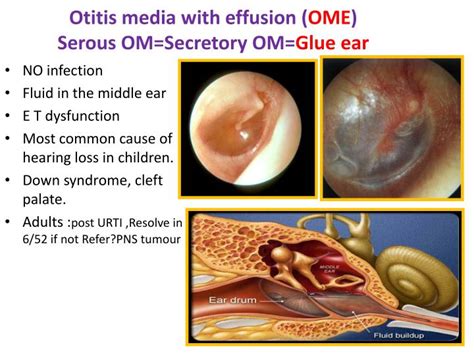 Otitis Media With Effusion Ome Treatment At Juan Fox Blog