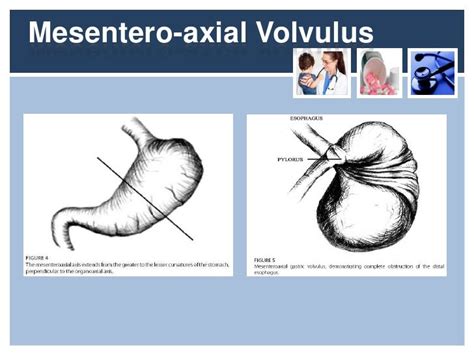 Gastric Volvulus