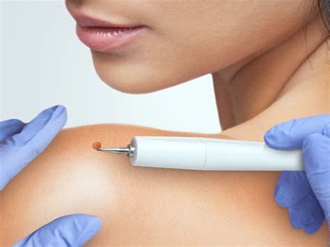 Skin Cancer Treatment Porter Premiere Dermatology And Surgery Center