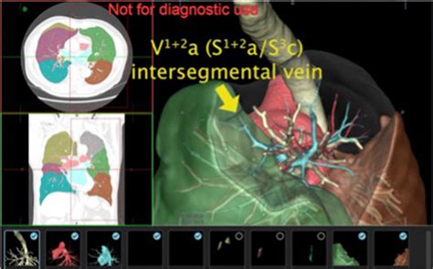 Segmentectomy Oriented Anatomical Model For Enhanced Precision Surgery Of The Left Upper Lobe