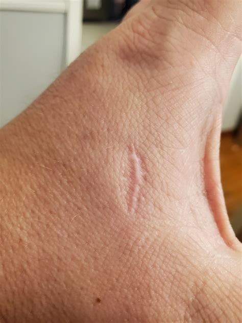 Scar Album On Imgur