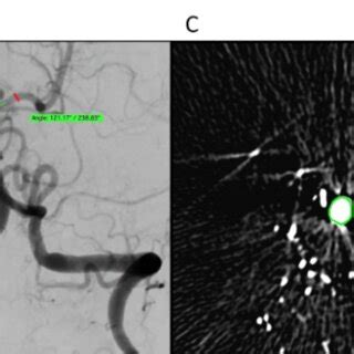 A Sample D DSA Image And WEB Device The Size Of The Device Is Not Download Scientific Diagram