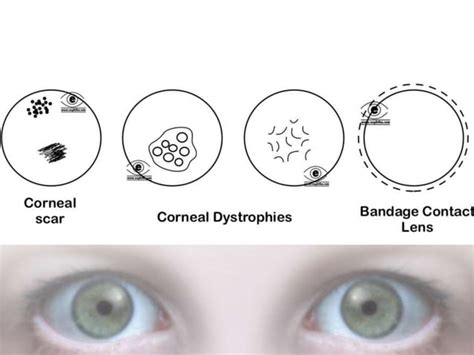 Eye Colour Coding Pptx