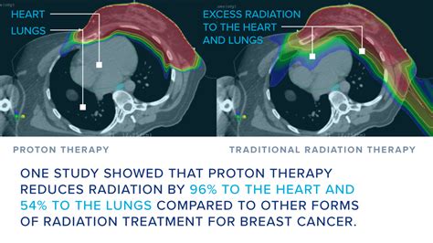 Proton Therapy For Breast Cancer Oklahoma Proton Therapy
