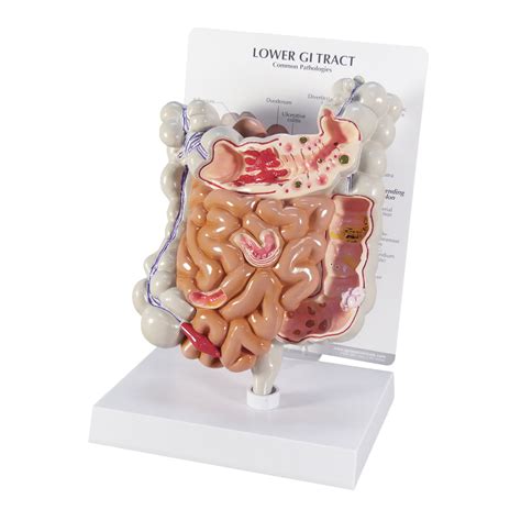 Gi Tract Model With Common Pathologies Gpi 3d Anatomy
