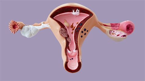 Know Your Growths The Differences Between A Polyp Cyst And Fibroids