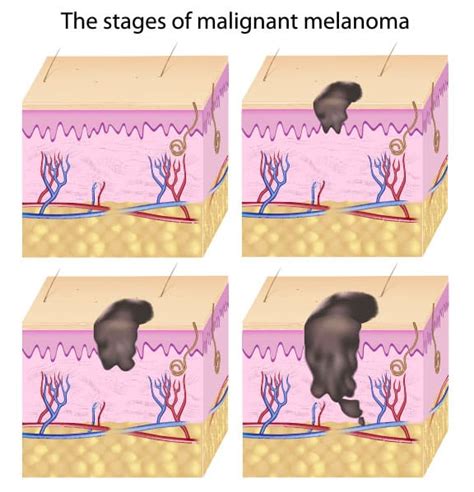 Skin Cancer Removal Near Me