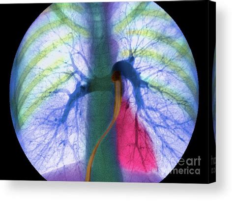 Coloured Angiogram Showing The Pulmonary Arteries Acrylic Print By Science Photo Library