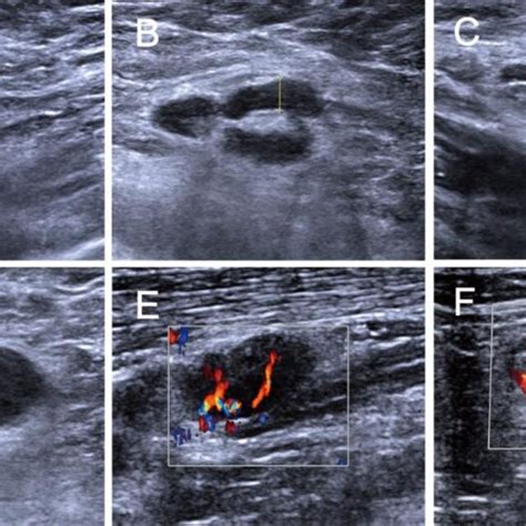 A The Measuring Approach Of Short Diameter Is Showed In A Short Axis
