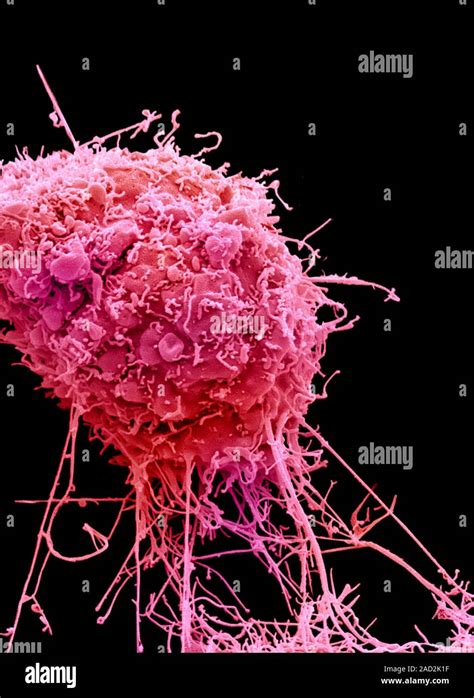 Cervical Cancer Cell Coloured Scanning Electron Micrograph Sem Of A Cultured Cancer Cell