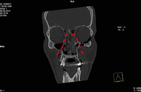 Heading The Ball A Case Of A Le Fort Ii Fracture In A Football Match Bmj Case Reports