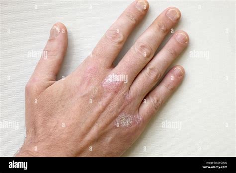 Health Skin Disease Psoriasis Illness Sickness Hand Health Macro Stock Photo Royalty Free Image