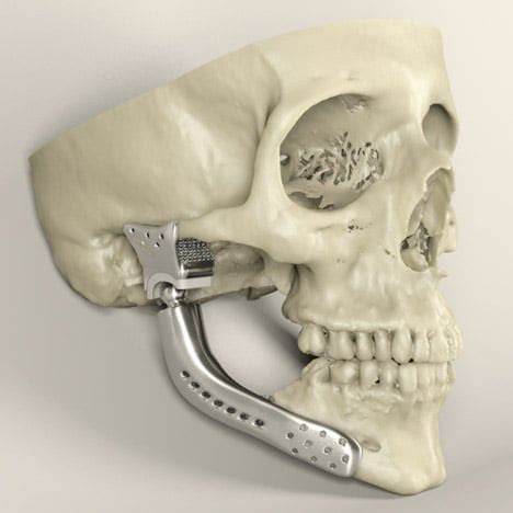 Movie D Printed Medical Implants By Sebastiaan Deviaene
