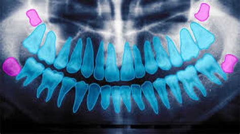 annotate radiology x ray ct and mri images by jobmunene fiverr