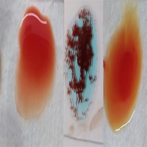 Blood Group Detection Object Detection Dataset V Am By Minor Project Th