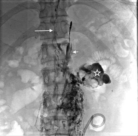 Dsa Image After Embolization The Glue Was In The Lower Part Of Download Scientific Diagram