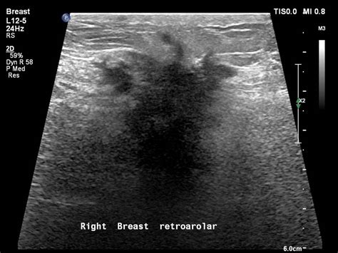 Atlas Of Breast Cancer Early Detection