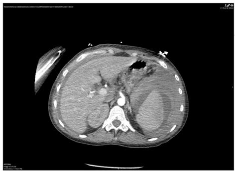 Complement Mediated Thrombotic Microangiopathy And Spontaneous Splenic