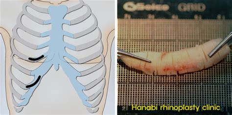 Primary Rhinoplasty Using Rib Cartilage Hanabi Rhinoplasty Clinic
