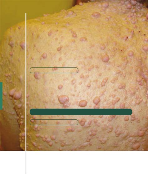 Neurocutaneous Disorders Notes Diagrams And Illustrations Osmosis