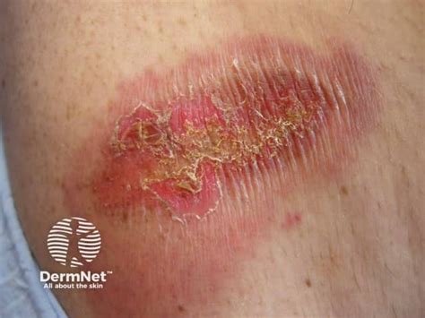Iodine Allergy Extensive Idiosyncratic Allergic Reaction To Non Ionic