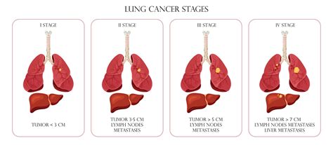 Lung Cancer Stages Concept Diseases Human Internal Organs Cartoon