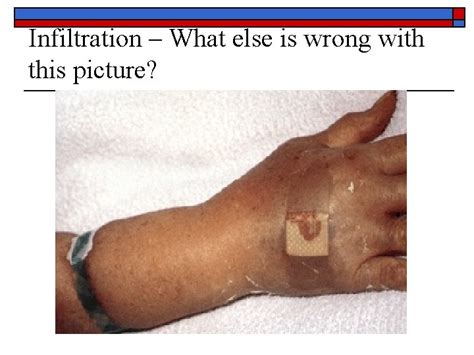 Complications Of Intravenous Therapy Principles Of Iv Therapy