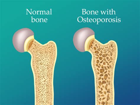 People With Osteoporosis