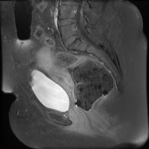 Uterus Didelphys Pictures