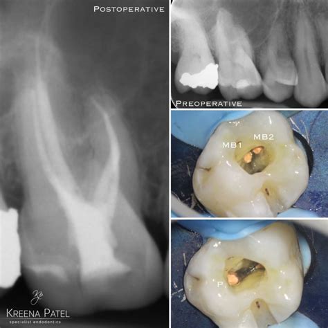 Kreena Patel On Linkedin Endodontics Crackedteeth